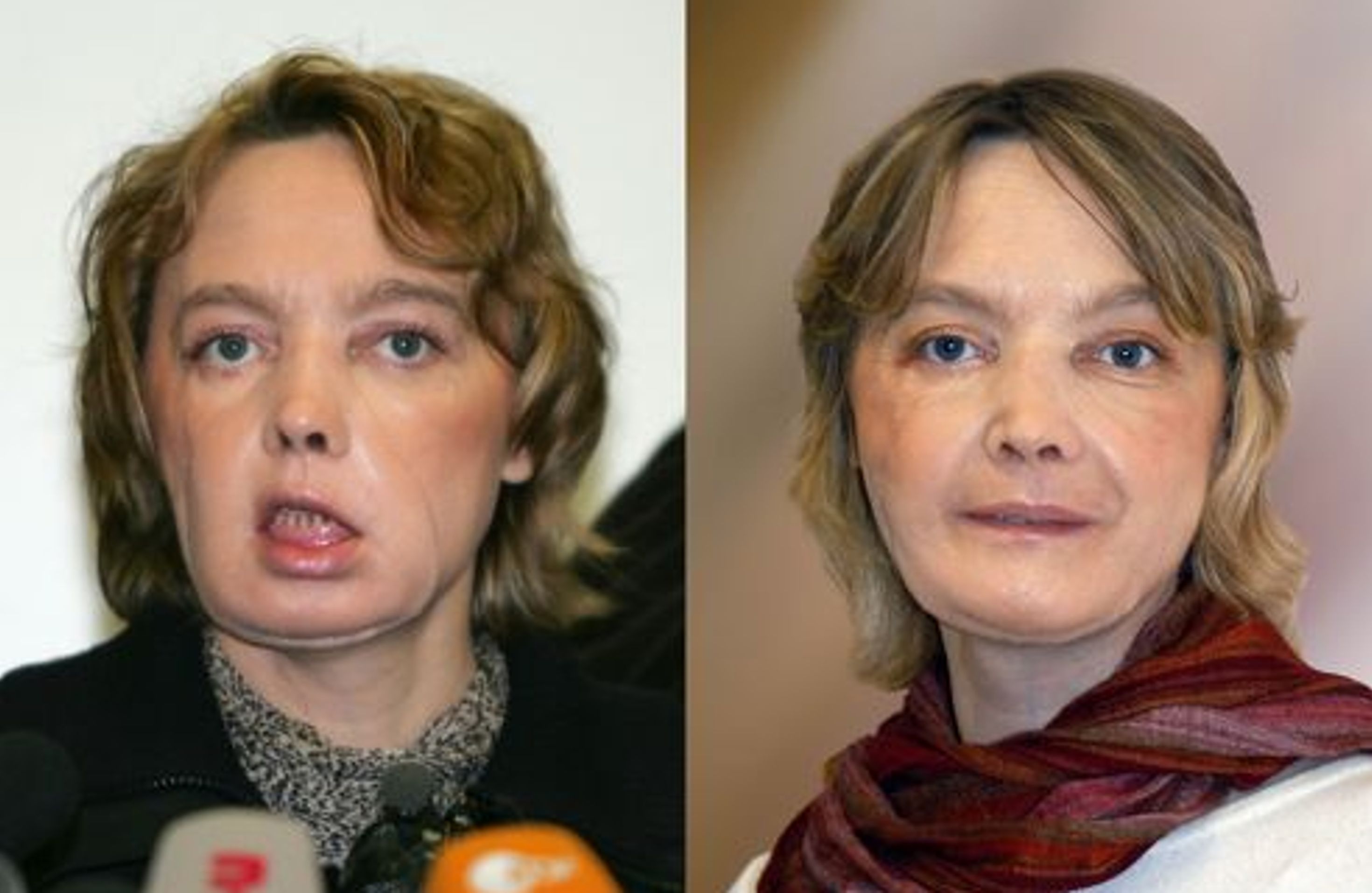 Première greffe du visage : 6 ans après, c'est une réussite (Photos)