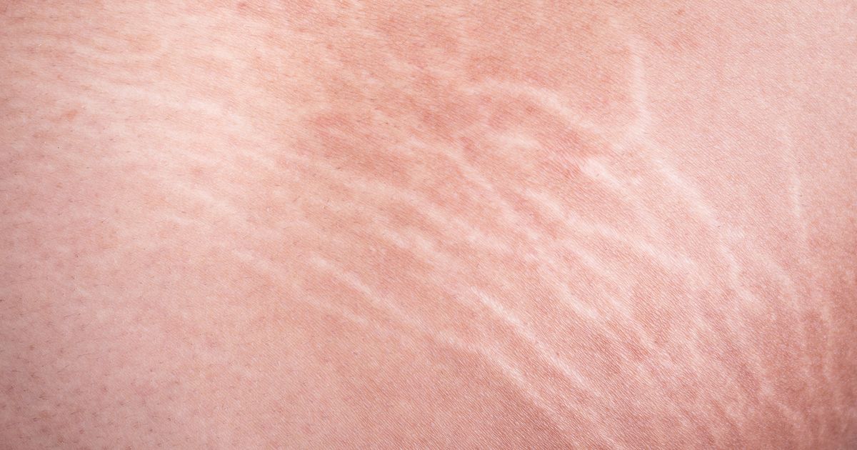 Un tatouage couleur chair pour faire disparaître les vergetures