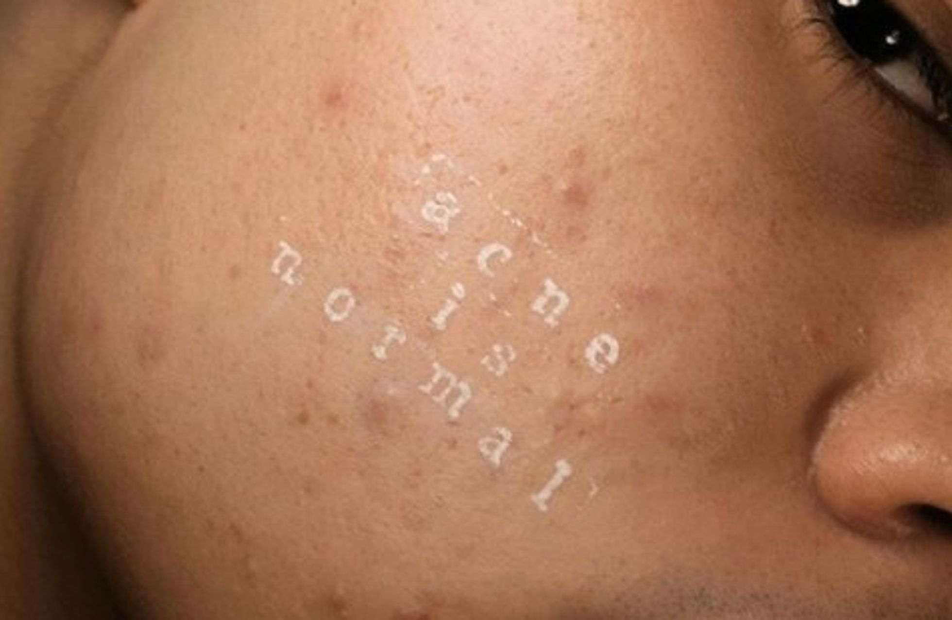 Pour normaliser l'acné, il refuse de retoucher ses photos