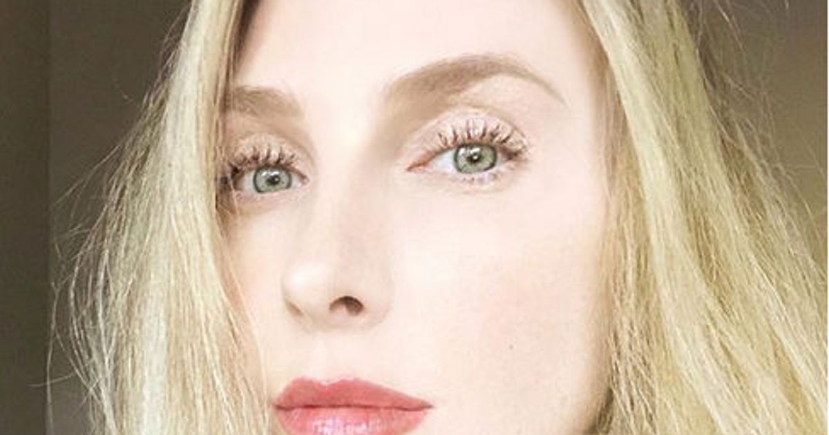 Chimérisme génétique : la peau de Taylor Muhl est de deux couleurs