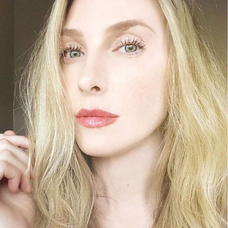 Chimérisme génétique : la peau de Taylor Muhl est de deux couleurs