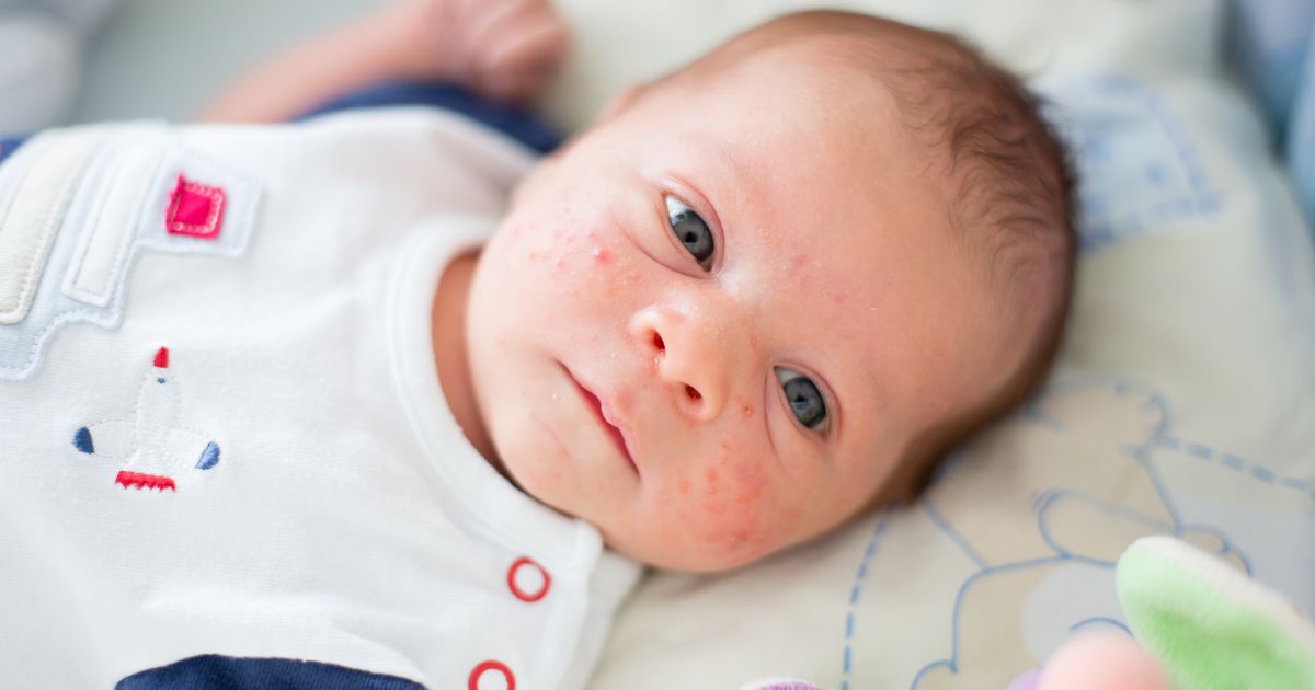 La roséole du bébé : tout savoir sur cette maladie infantile