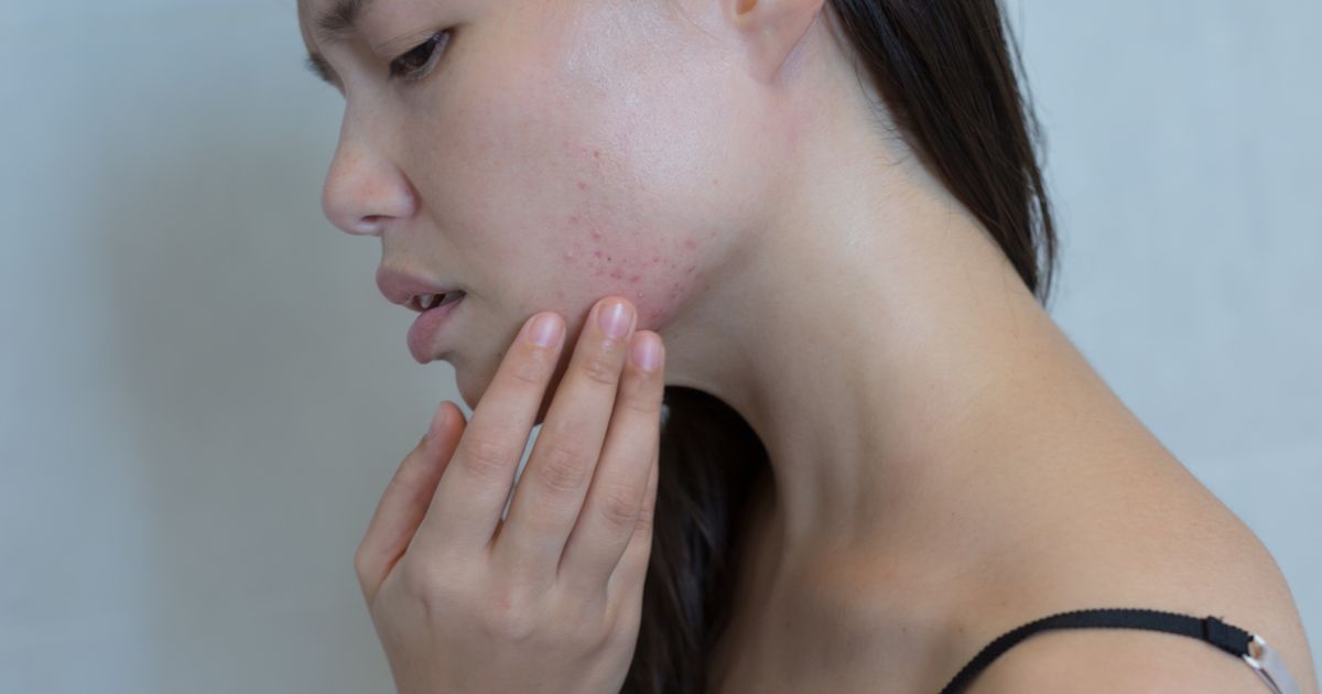 tout savoir sur l’acné pendant la grossesse