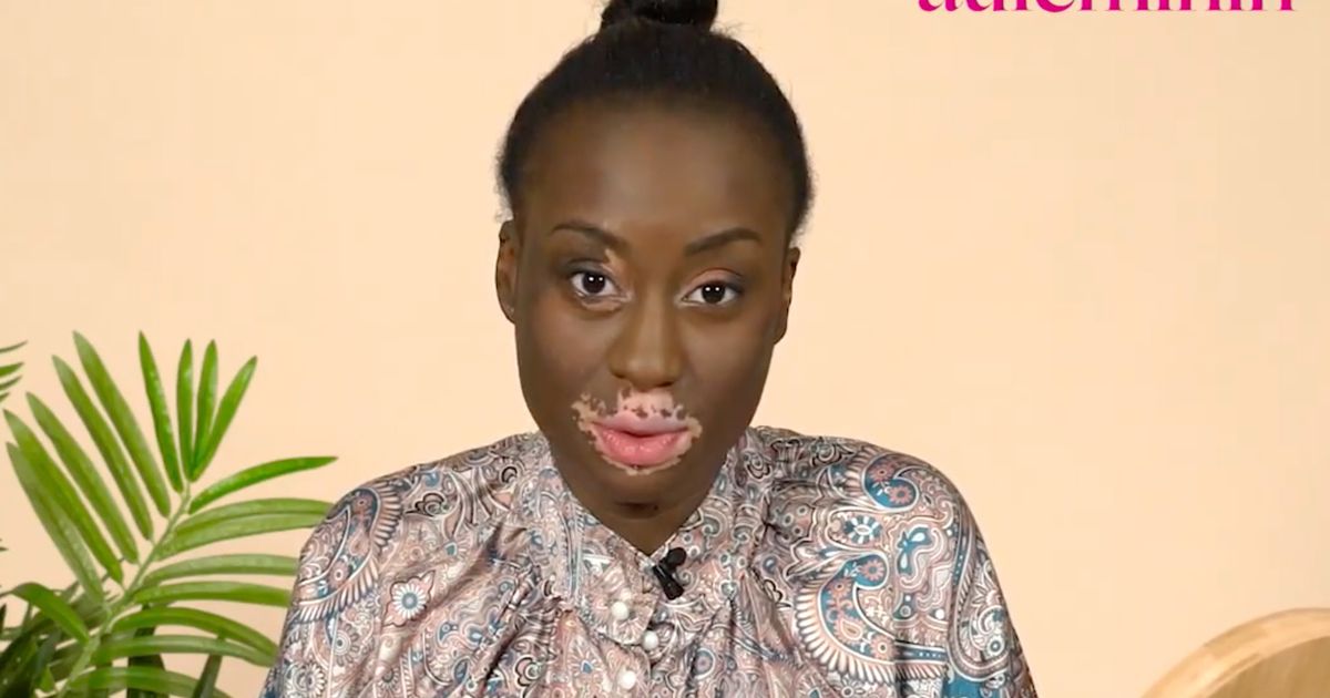 "Le vitiligo, c'est devenu ma force", Estelle Mendy se confie sans ...