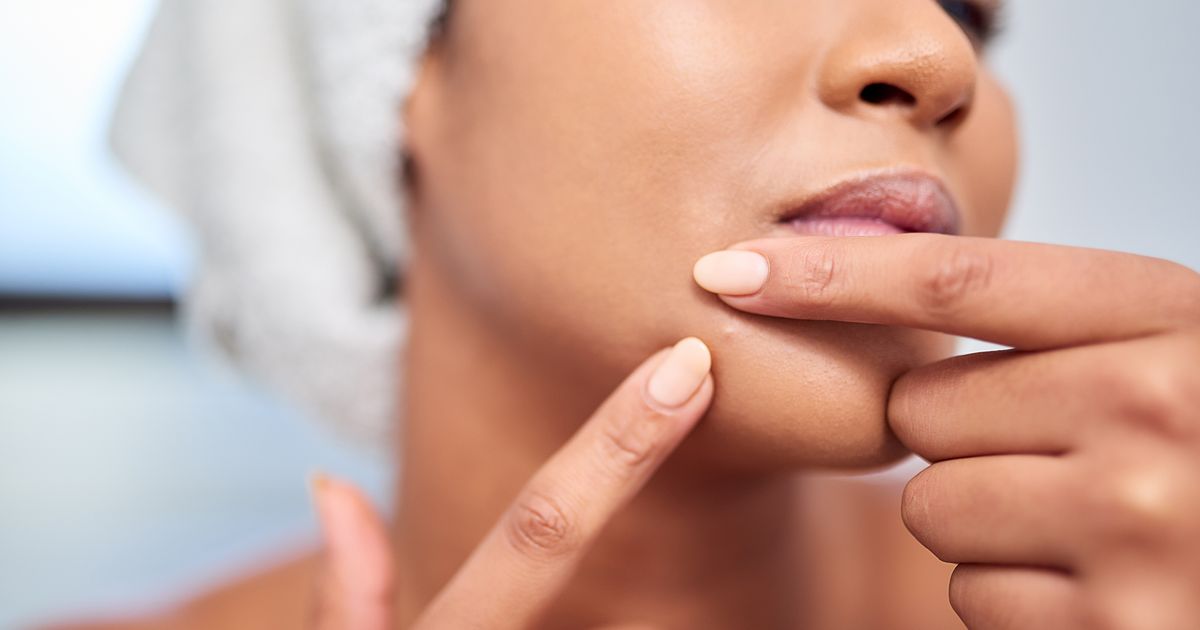 Bouton au menton : comment s’en débarrasser