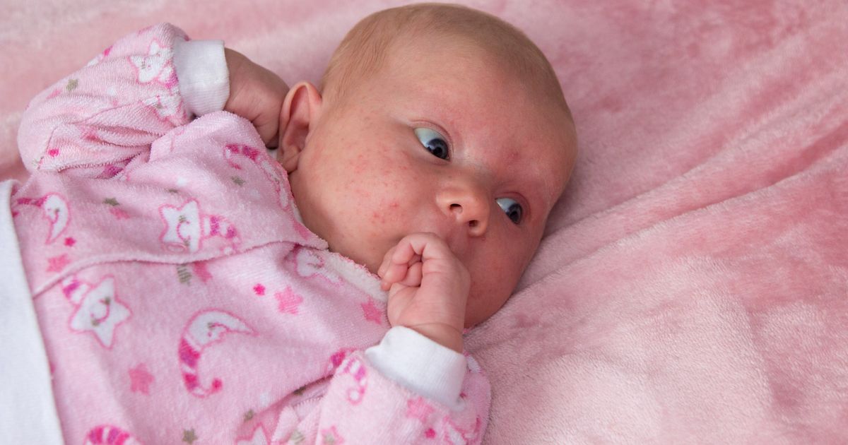 Boutons de chaleur : pourquoi ces petits boutons disgracieux recouvrent ...