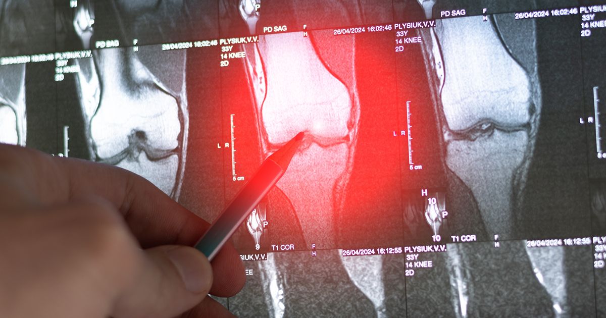 Cancer des os : voici les 4 principaux symptômes à repérer (et 4 autres ...
