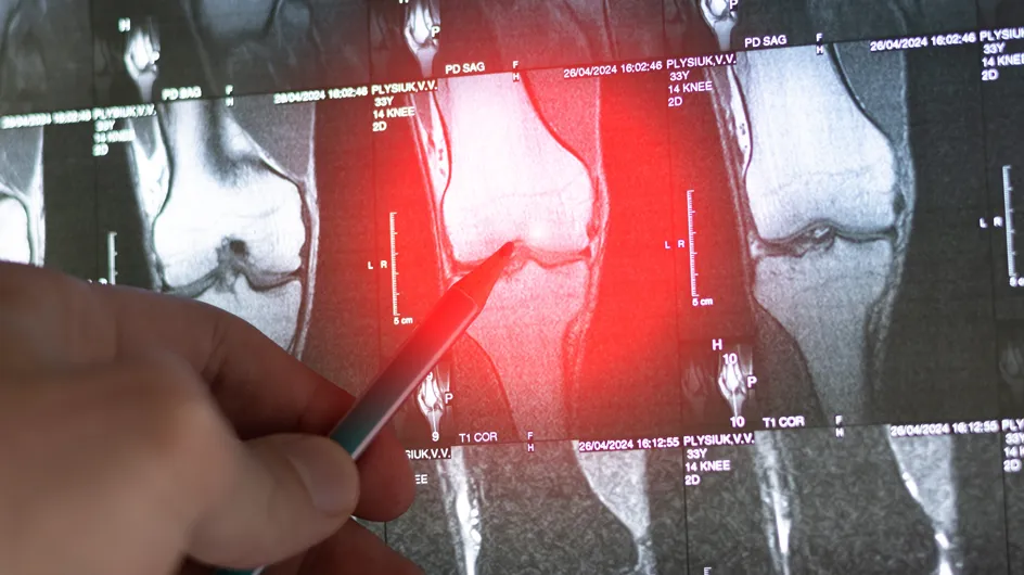 Cancer des os : voici les 4 principaux symptômes à repérer (et 4 autres ...