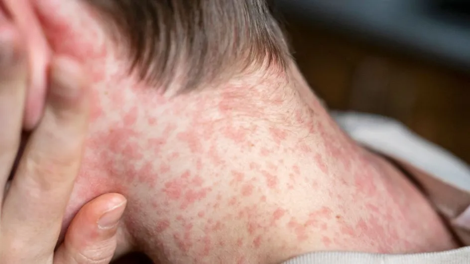 La rougeole explose en France et elle est très contagieuse : voici les ...
