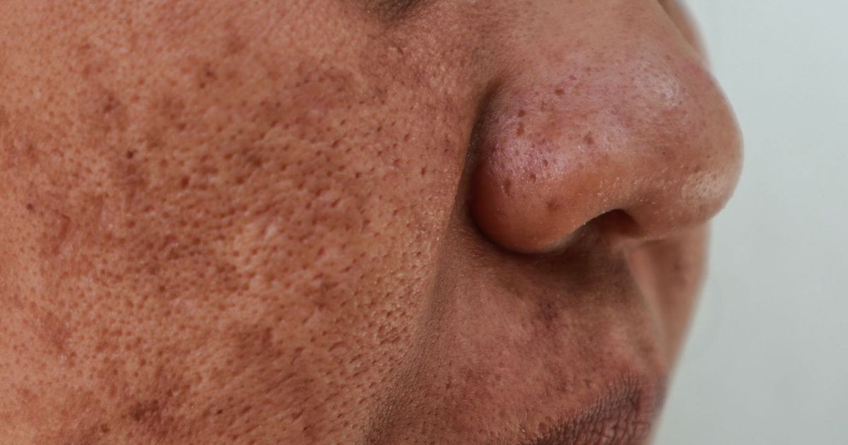 Cloasma: cos’è e come si cura