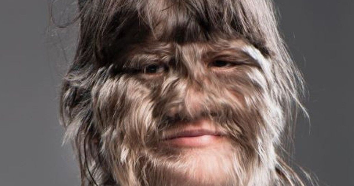 La "fille la plus poilue du monde" est méconnaissable aujourd'hui